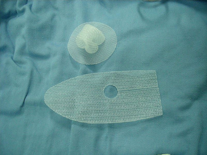 5 Examples of Hernia Mesh Complications